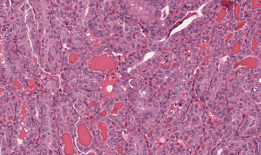 What Is Atypical Follicular Cells Of Thyroid